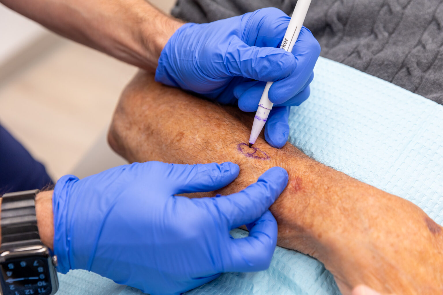 Excision Surgery in Waterloo | Premier Dermatology